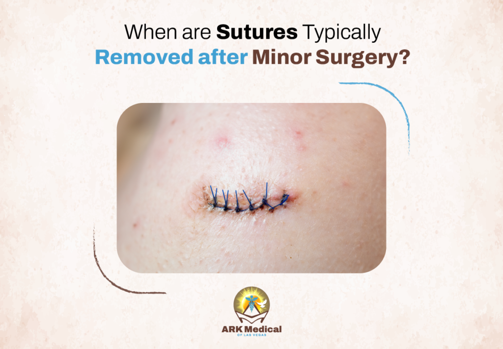 When are Sutures Typically Removed after Minor Surgery?